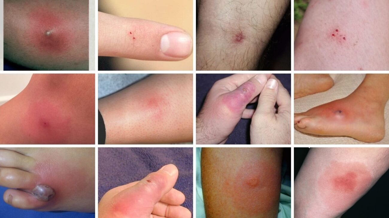 37 Types Of Spider Bites Identification With Pictures Symptoms 